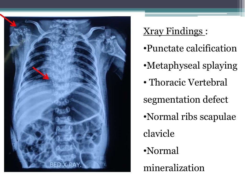 Case - Rhizomelic chondrodysplasia punctata