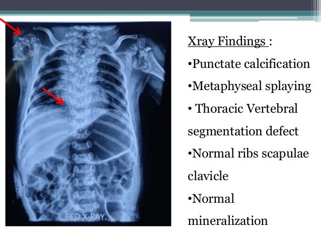 Case - Rhizomelic chondrodysplasia punctata