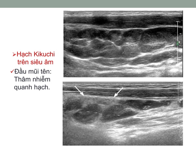 Kikuchi Disease | PPTX