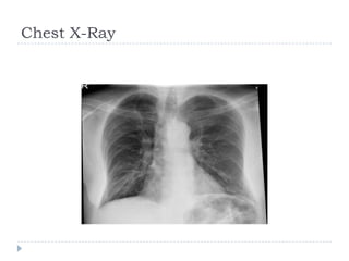 right middle lobe syndrome | PPTX