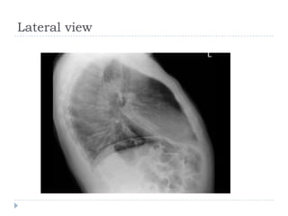 right middle lobe syndrome | PPTX