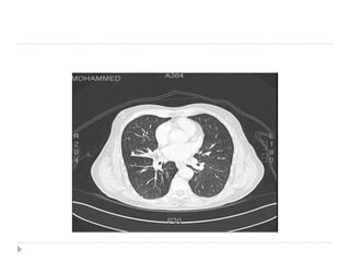 right middle lobe syndrome | PPTX