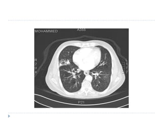 right middle lobe syndrome | PPTX
