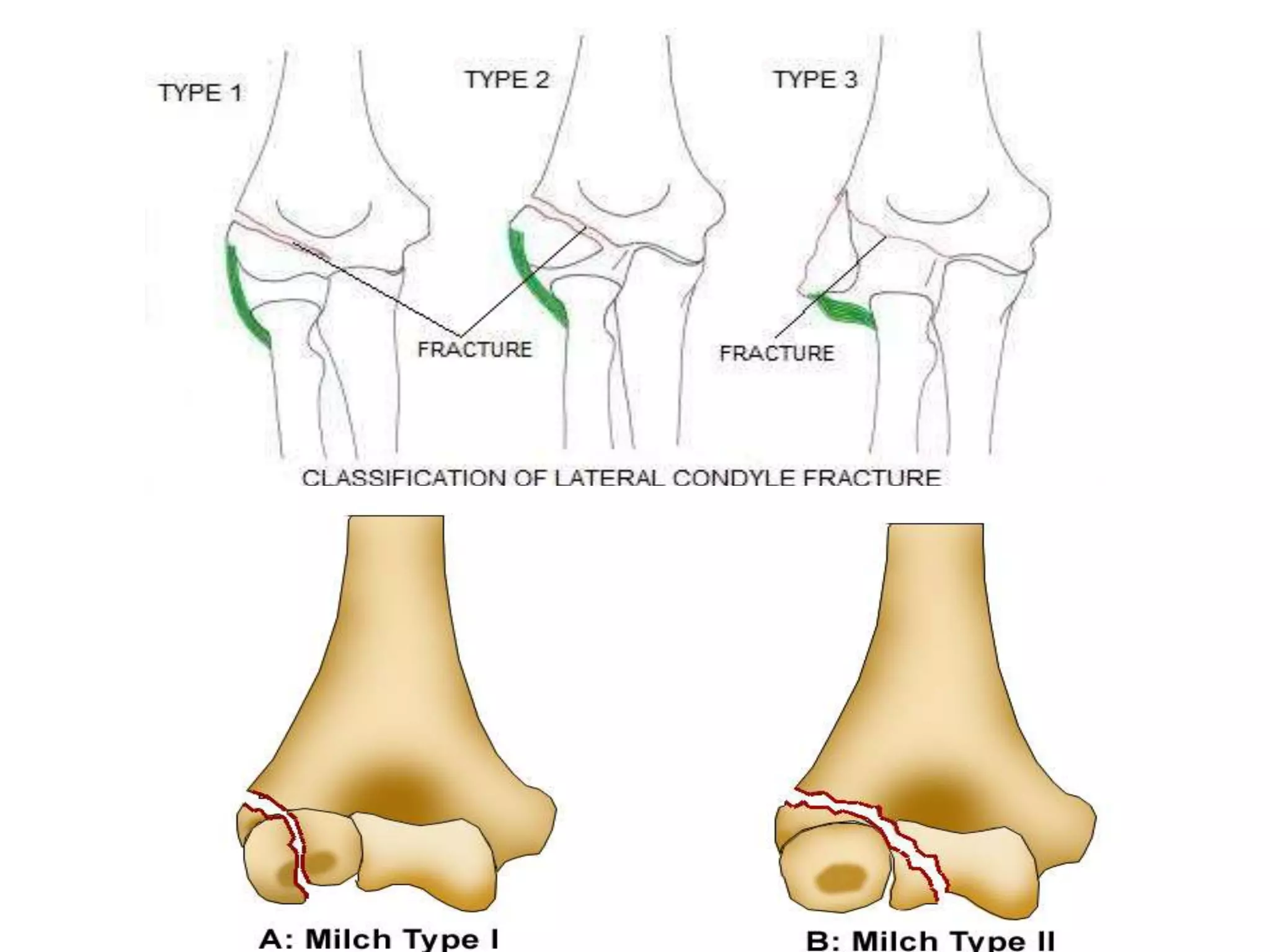 Case discussion lateral condyle fracture | PPTX