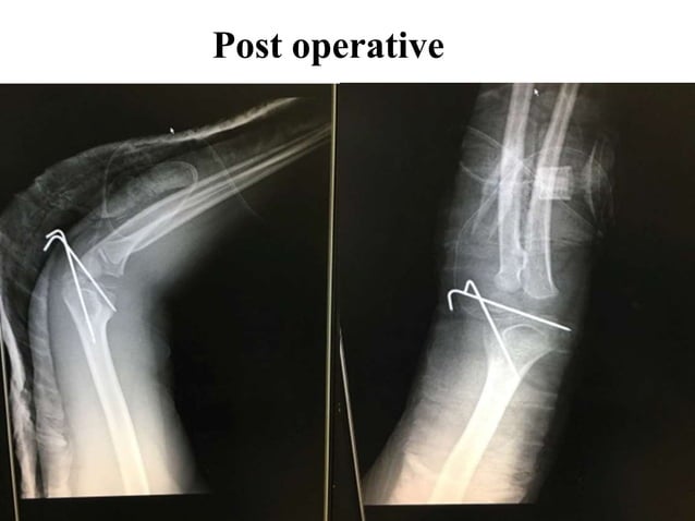 Case discussion lateral condyle fracture | PPT