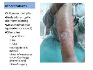 Leg ulcer D/Ds | PPTX