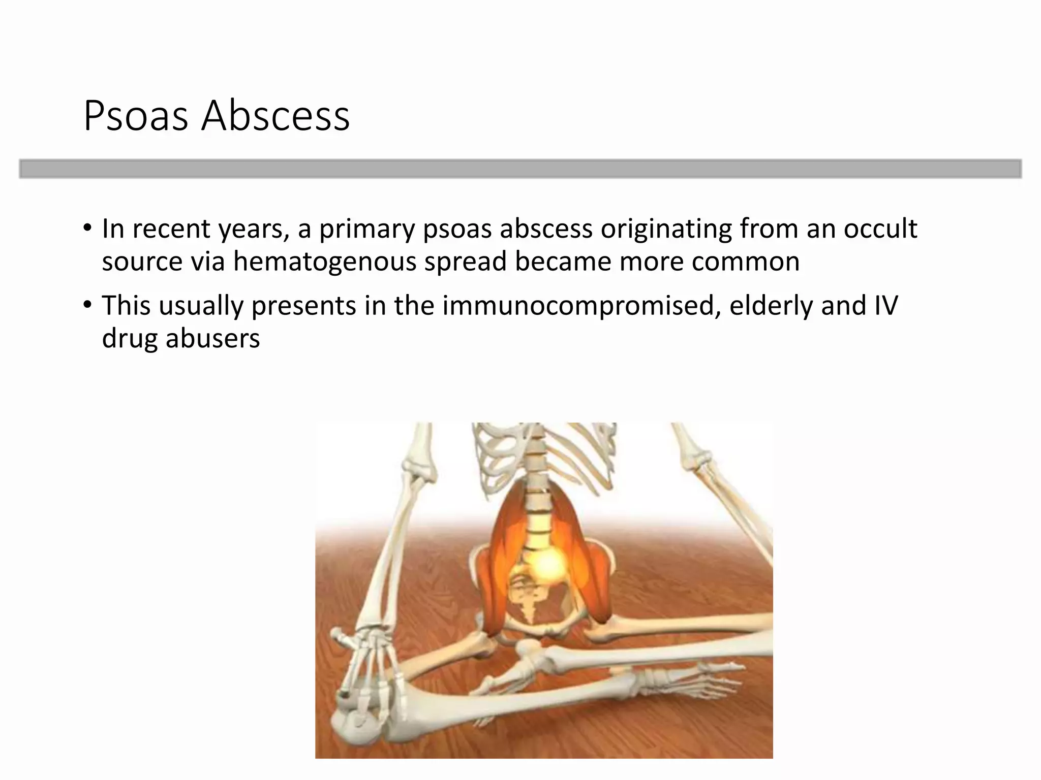 Psoas Abscess | PPTX