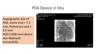 Case presentation on PDA | PPTX
