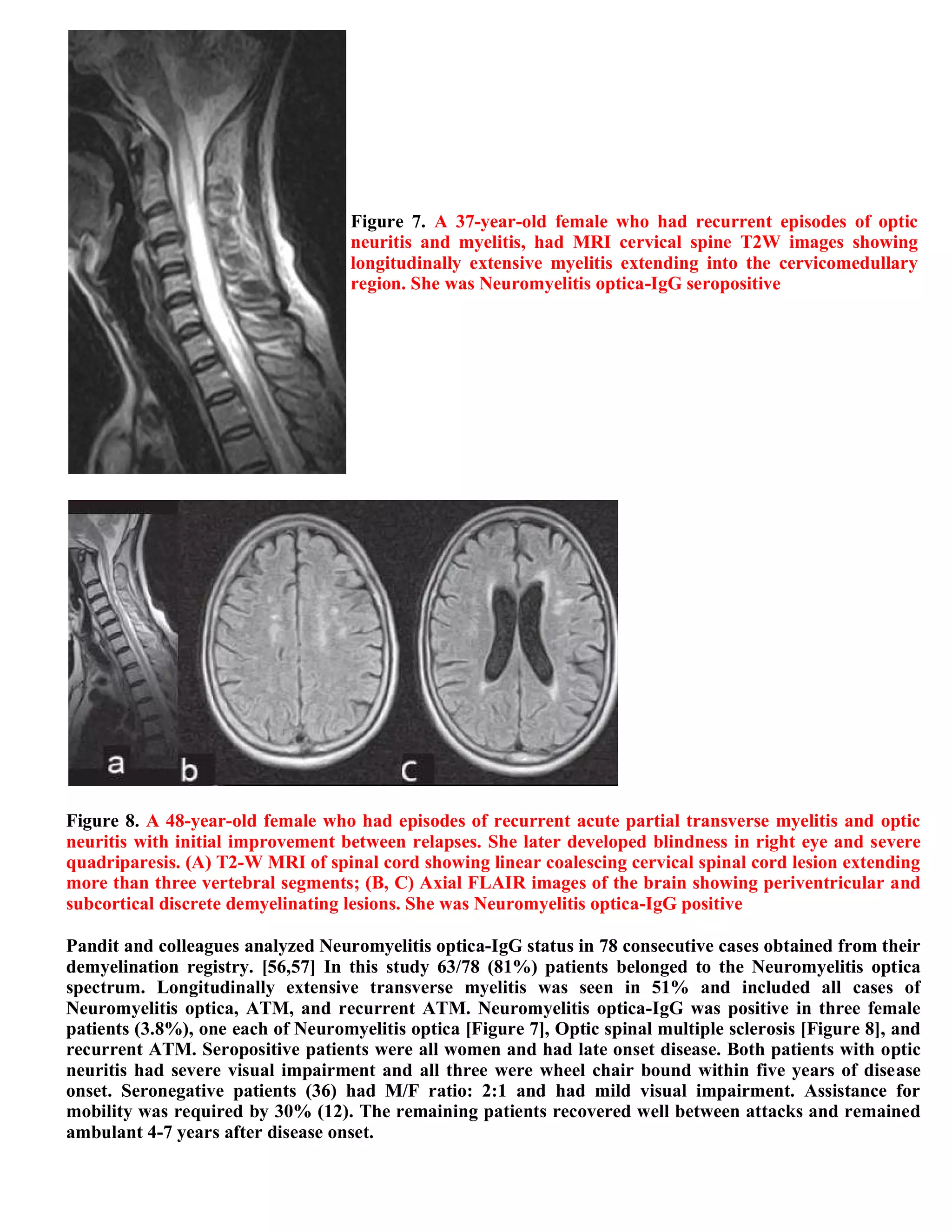 Case record...Acute postinfectious transverse myelitis (Transverse ...
