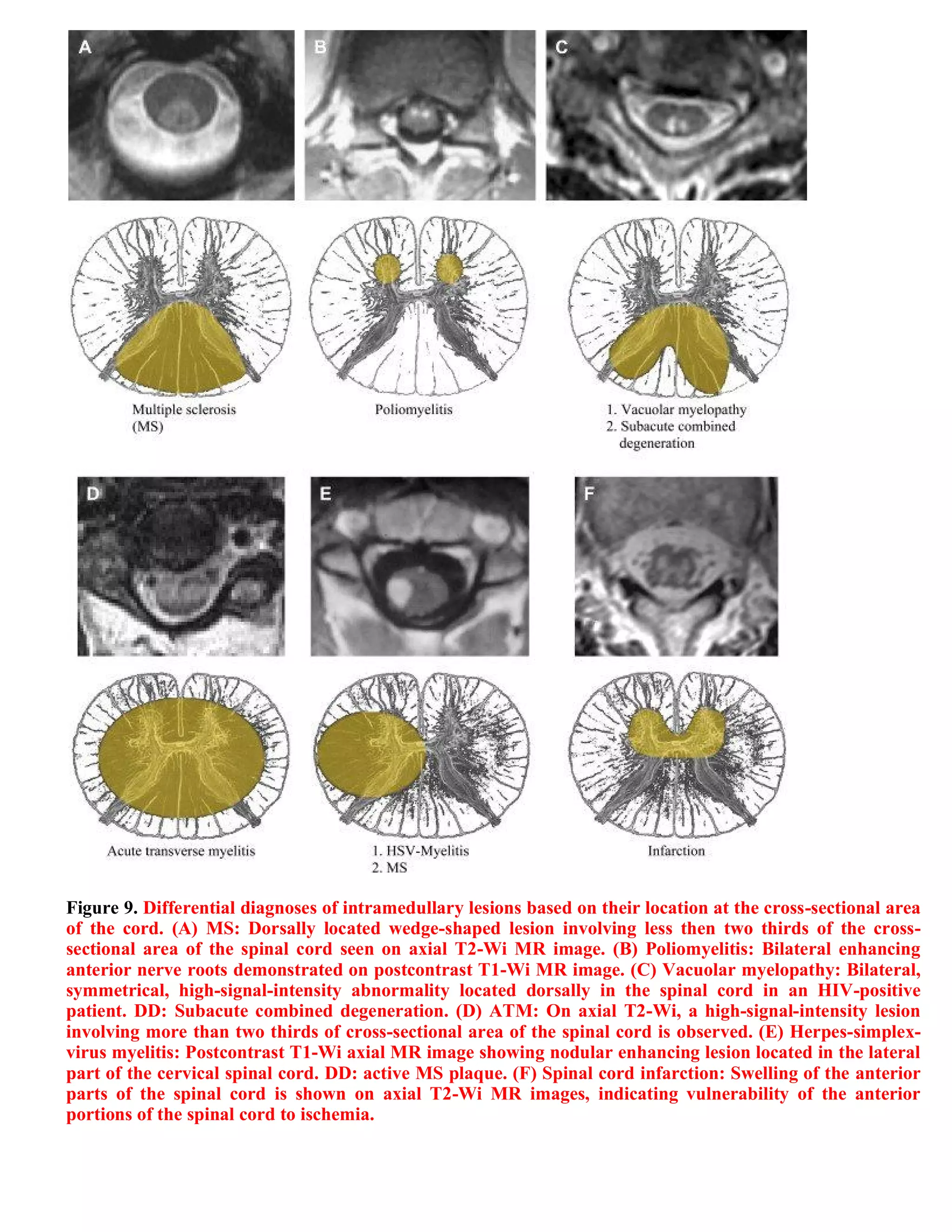 Case record...Acute postinfectious transverse myelitis (Transverse ...