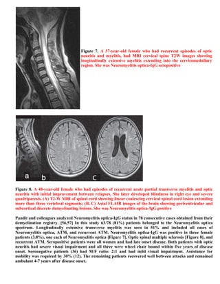 Case record...Acute postinfectious transverse myelitis (Transverse ...