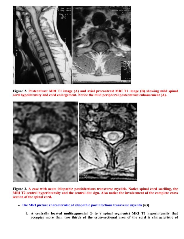 Case record...Acute postinfectious transverse myelitis (Transverse ...