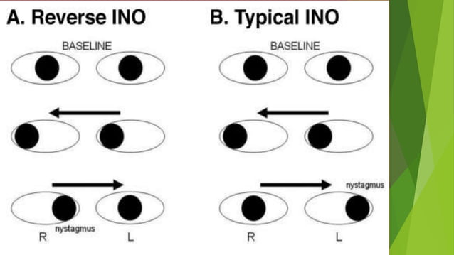 CASE-REVERSE detailed formats in_INO.pptx
