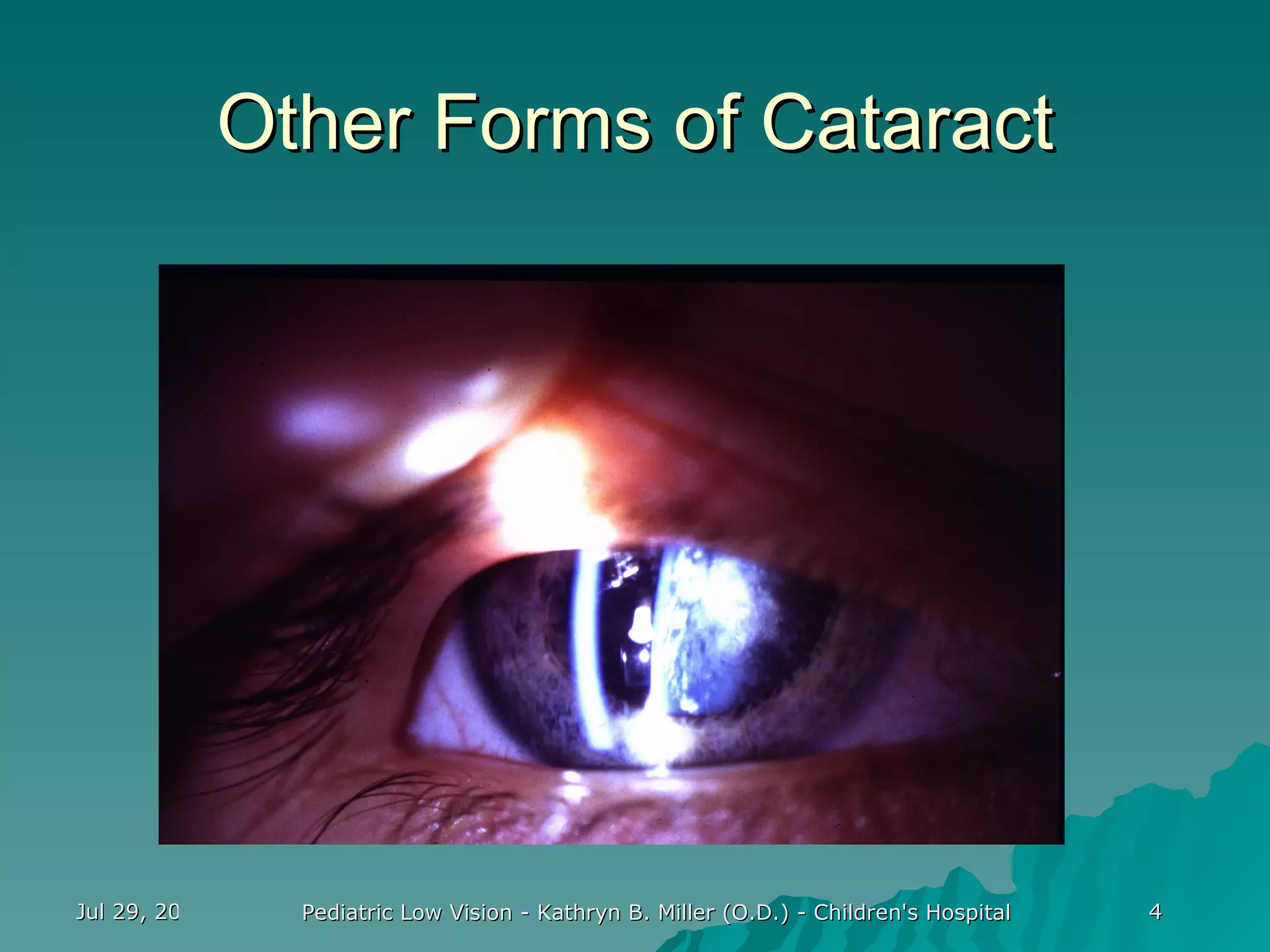 Case Study: Congenital Cataracts | PPT
