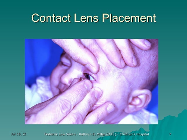 Case Study: Congenital Cataracts | PPT