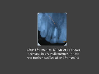 MTA Apexification | PPTX