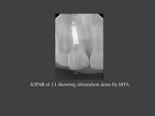 MTA Apexification | PPTX