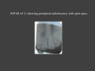 MTA Apexification | PPTX