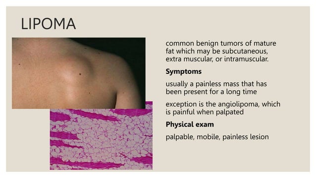 CASE 1-Surgery Excision Lipoma.pptx | Physical Therapy | Wellness
