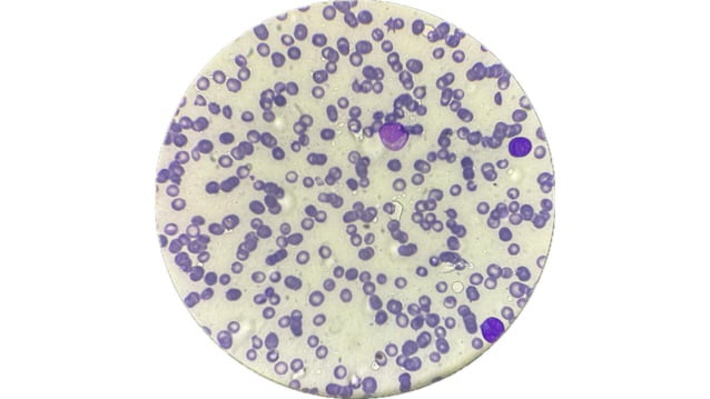case 10 acute myeloid leukemia aml m2.pptx