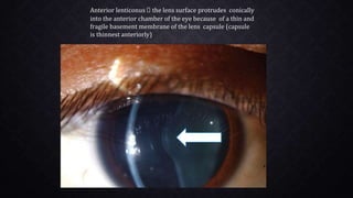 Case 11-Alport Syndrome presentation.pptx | Eye and Vision Conditions ...