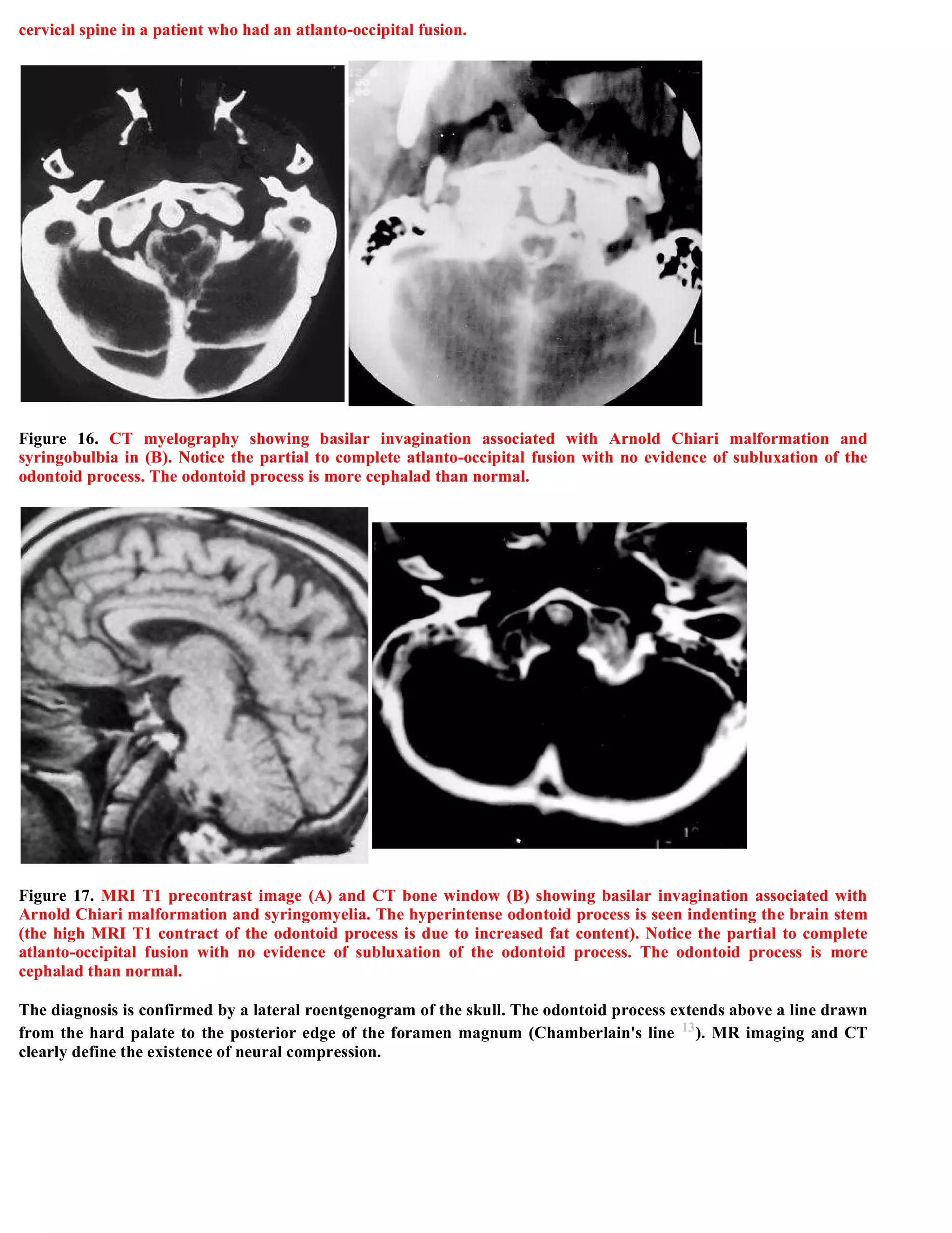 Case record...Congenital craniocervical anomalies | PDF