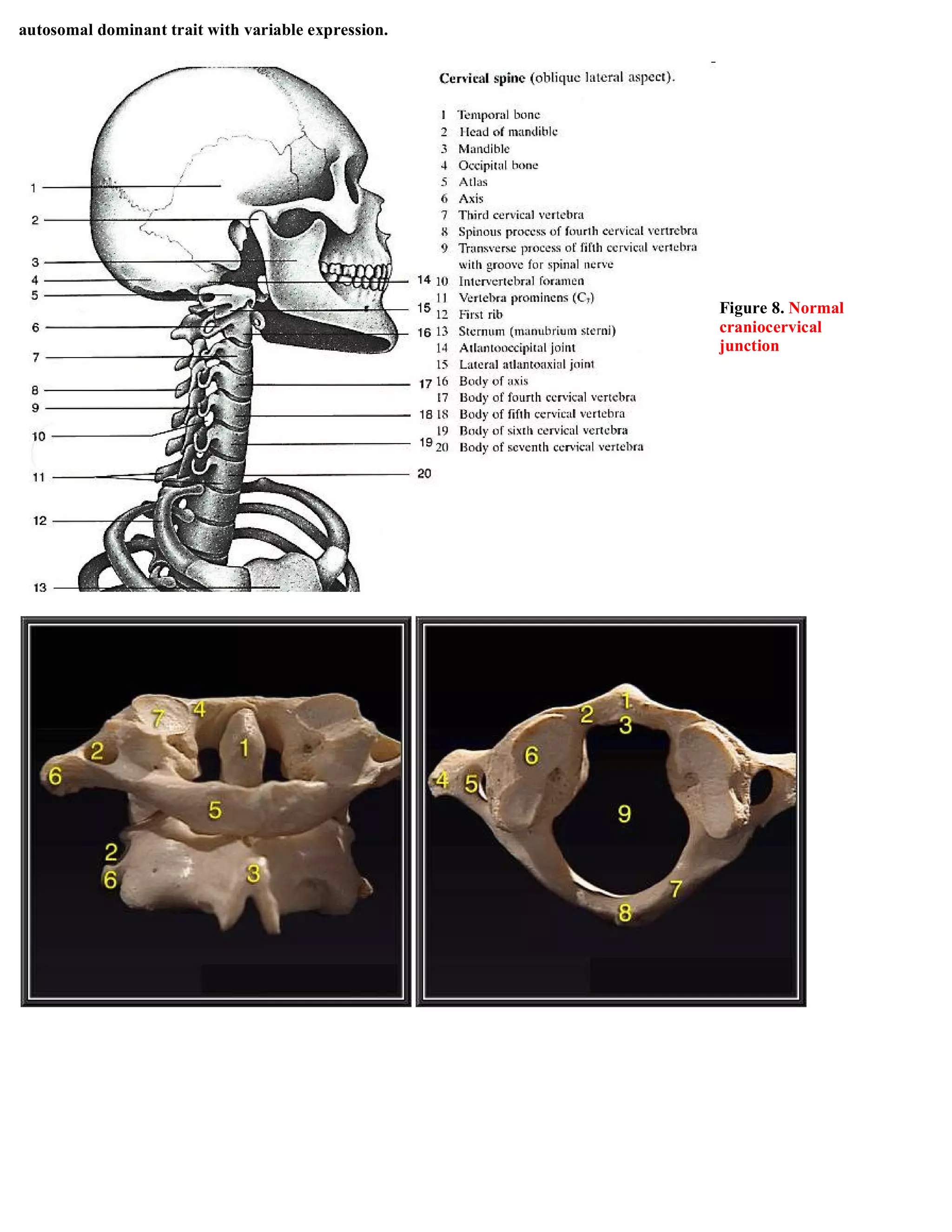 Case record...Congenital craniocervical anomalies | PDF