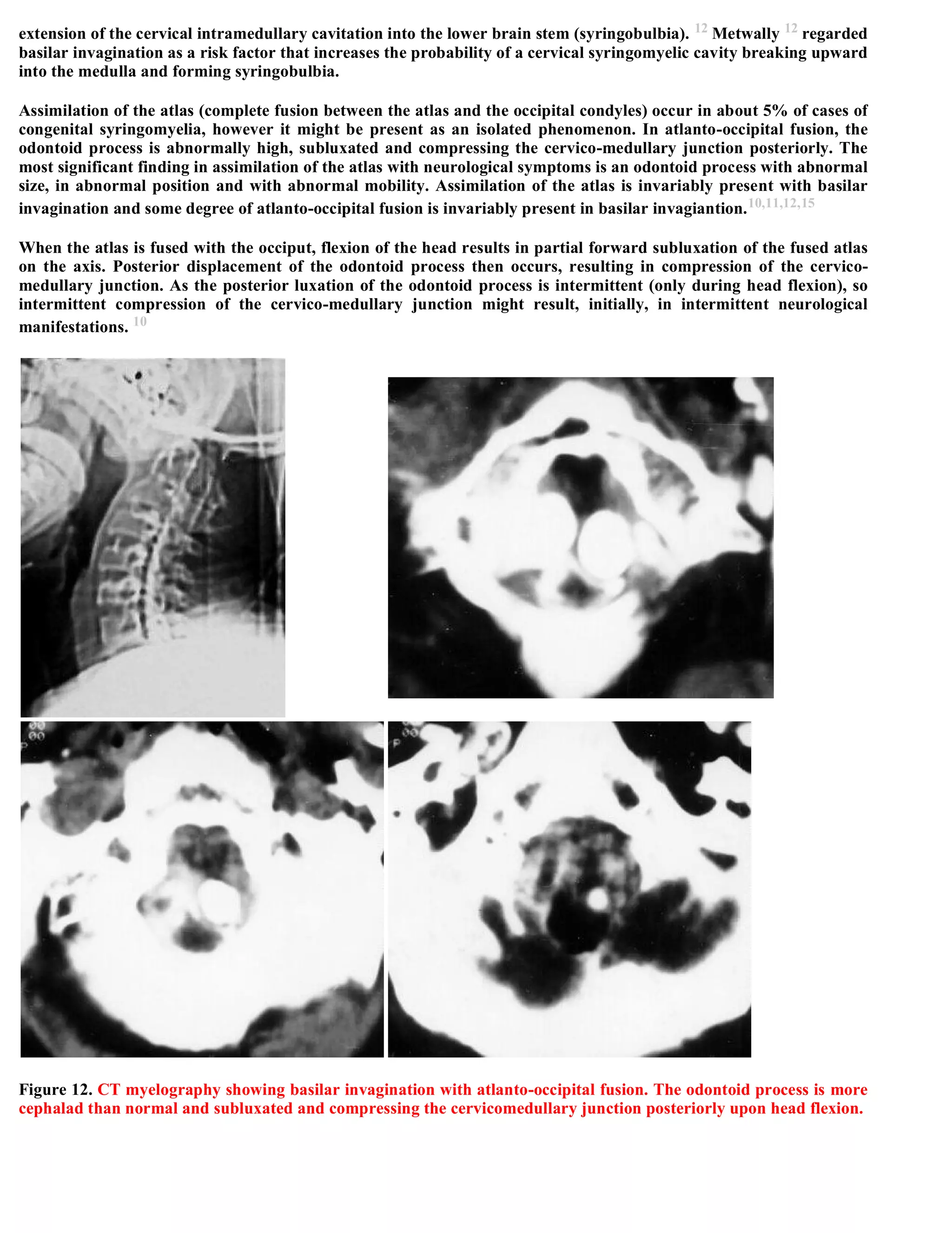 Case record...Congenital craniocervical anomalies | PDF