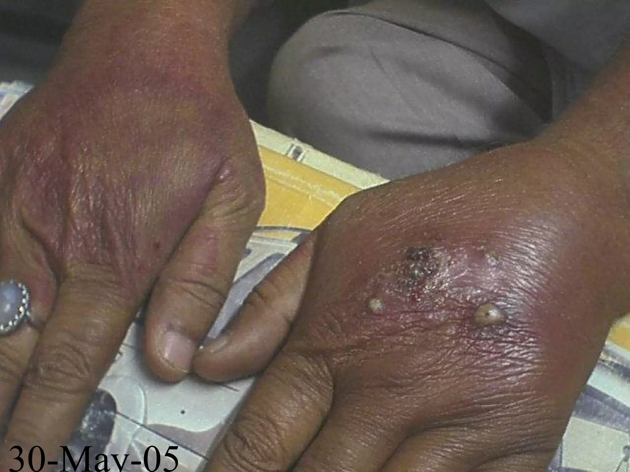 Infection on dorsum of hand | PPT