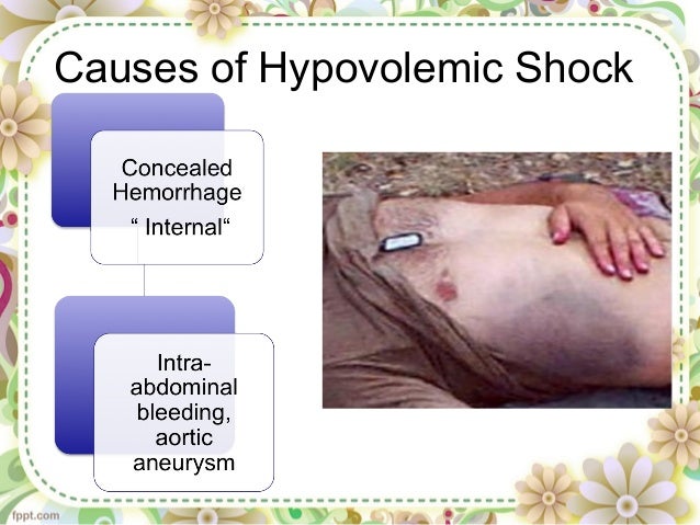 Hypovolemic Shock