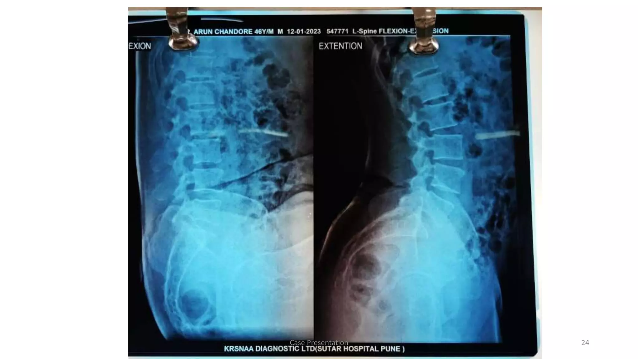 Physiotherapy Case presentation | PPTX