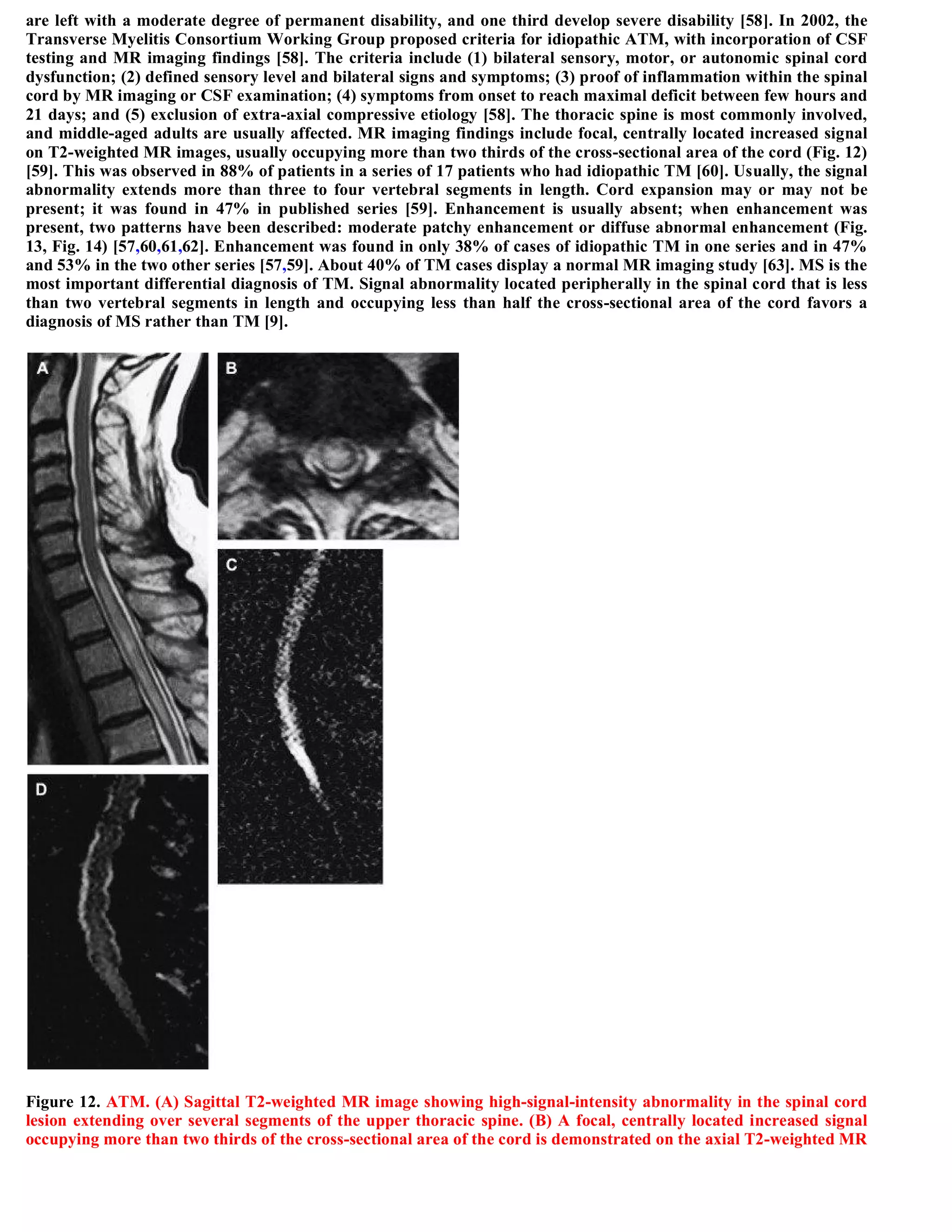 Case record...Spinal multiple sclerosis | PDF