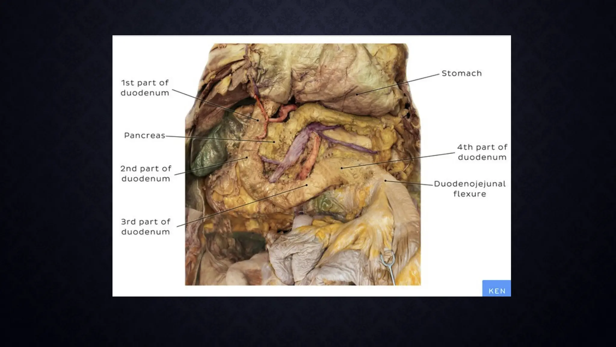 PANCREATIC NEUROENDOCRINE TUMORS RADIOLOGY | PPTX