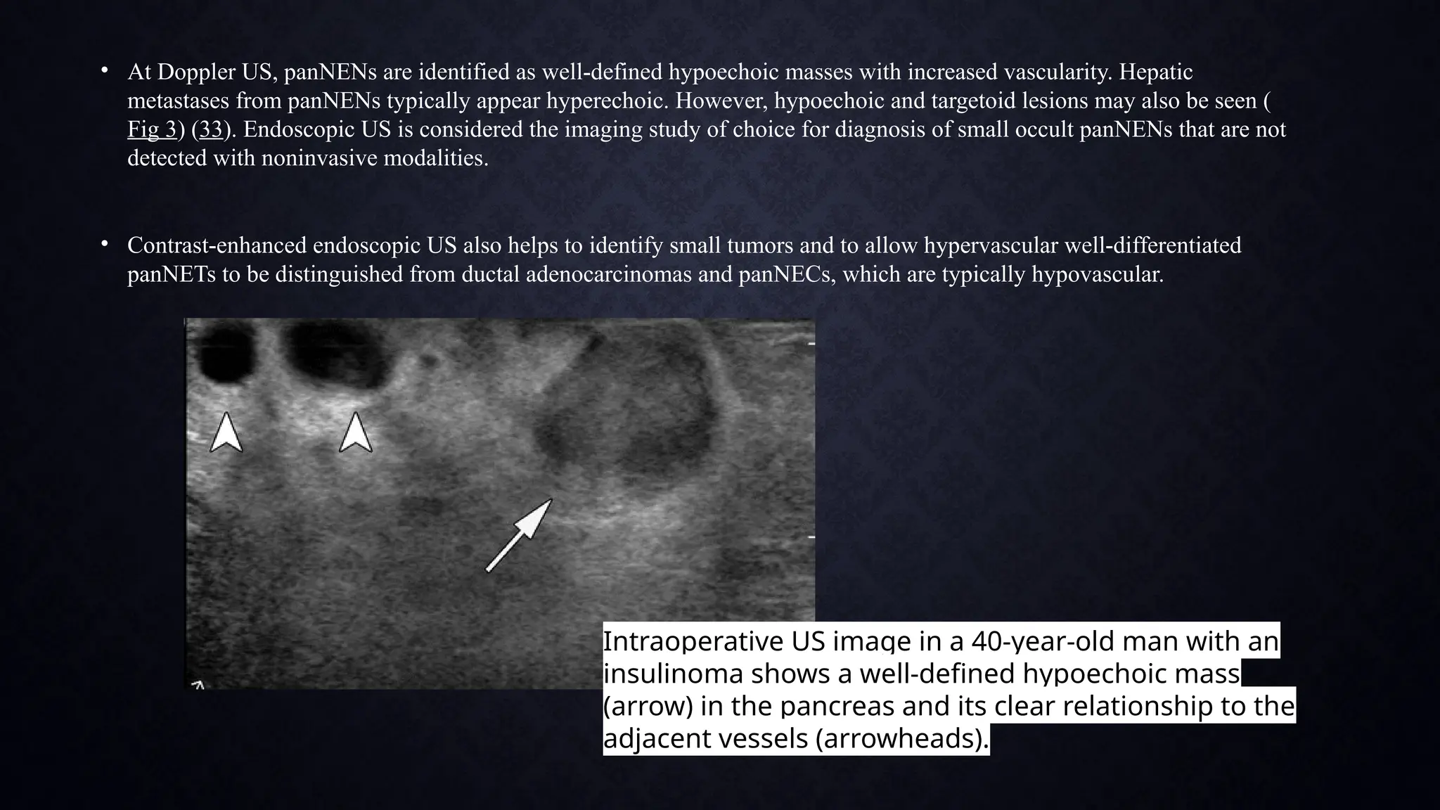 PANCREATIC NEUROENDOCRINE TUMORS RADIOLOGY | PPTX