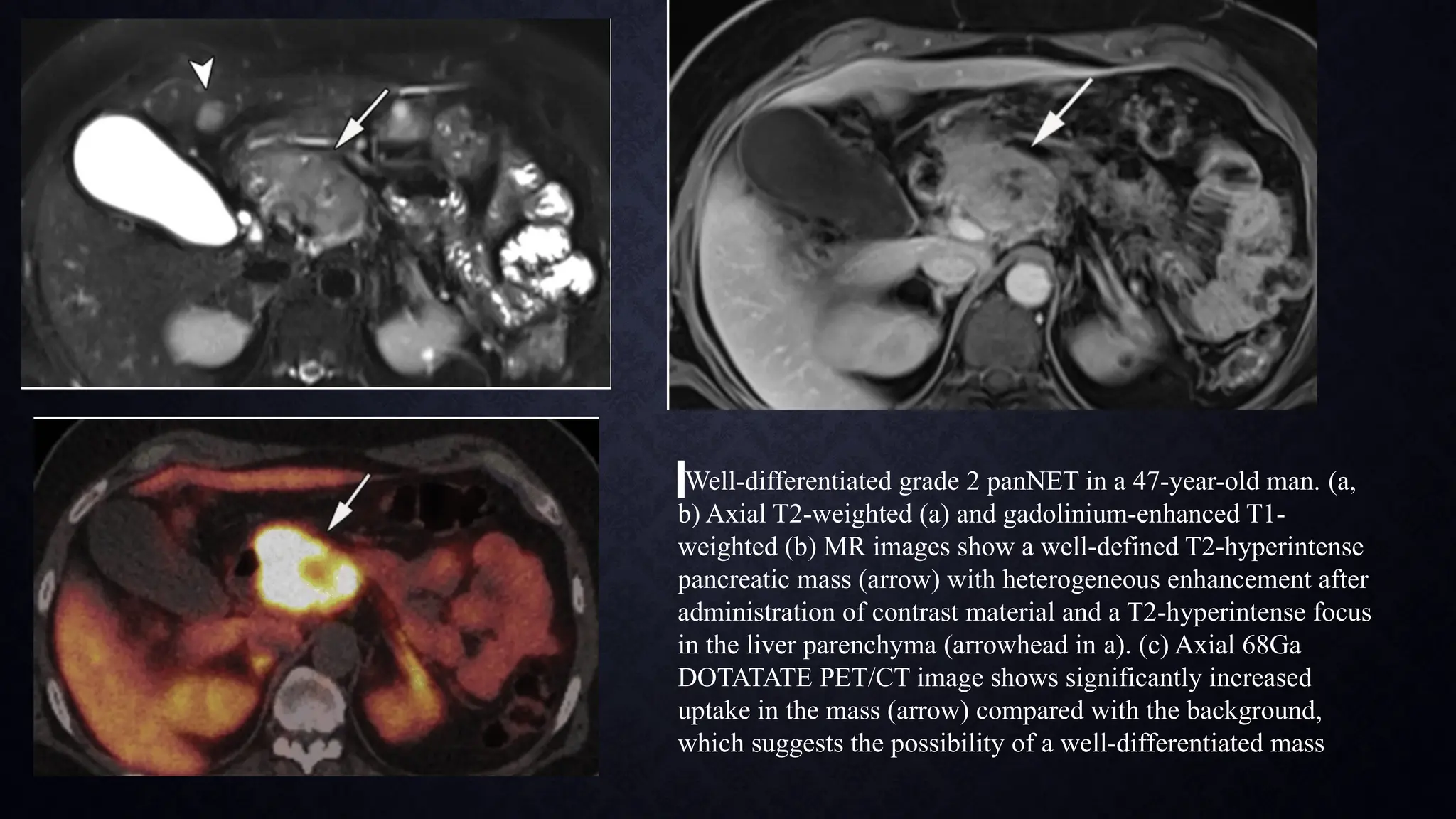 PANCREATIC NEUROENDOCRINE TUMORS RADIOLOGY | PPTX