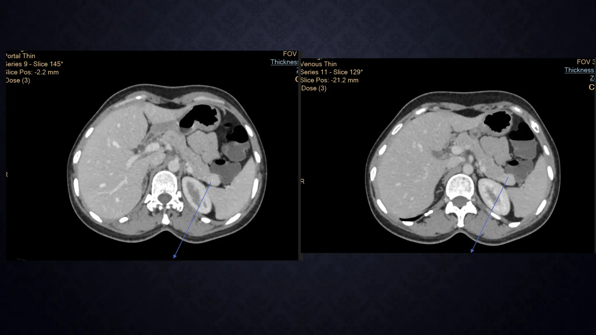 PANCREATIC NEUROENDOCRINE TUMORS RADIOLOGY | PPTX