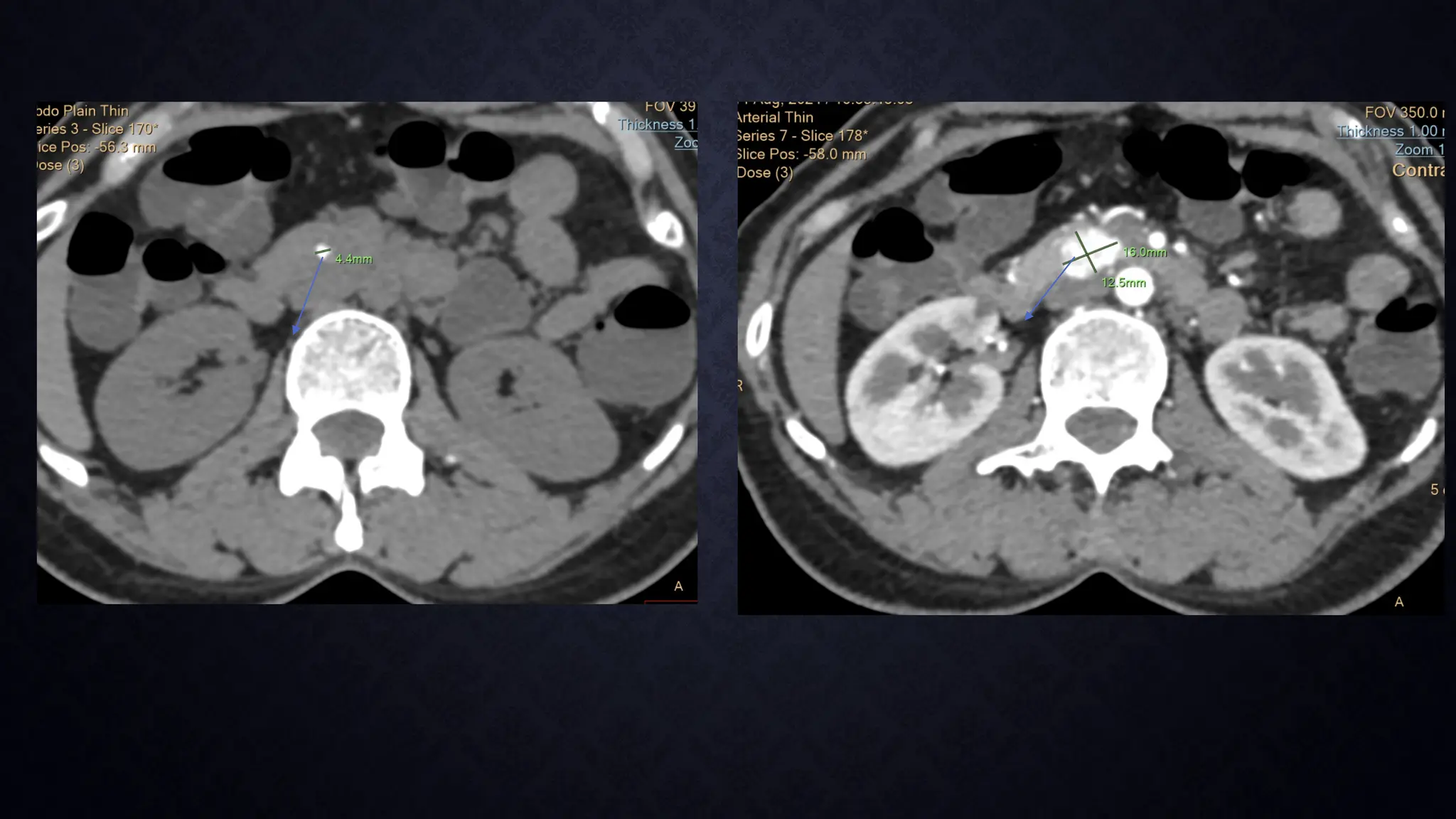 PANCREATIC NEUROENDOCRINE TUMORS RADIOLOGY | PPTX