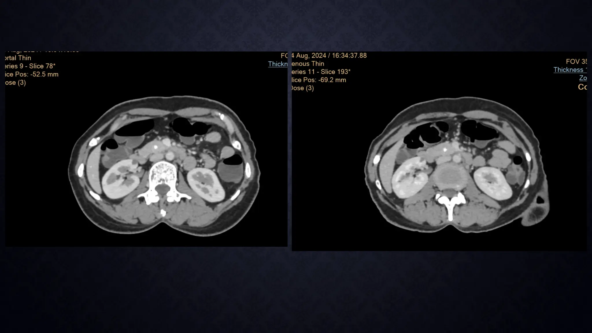 PANCREATIC NEUROENDOCRINE TUMORS RADIOLOGY | PPTX