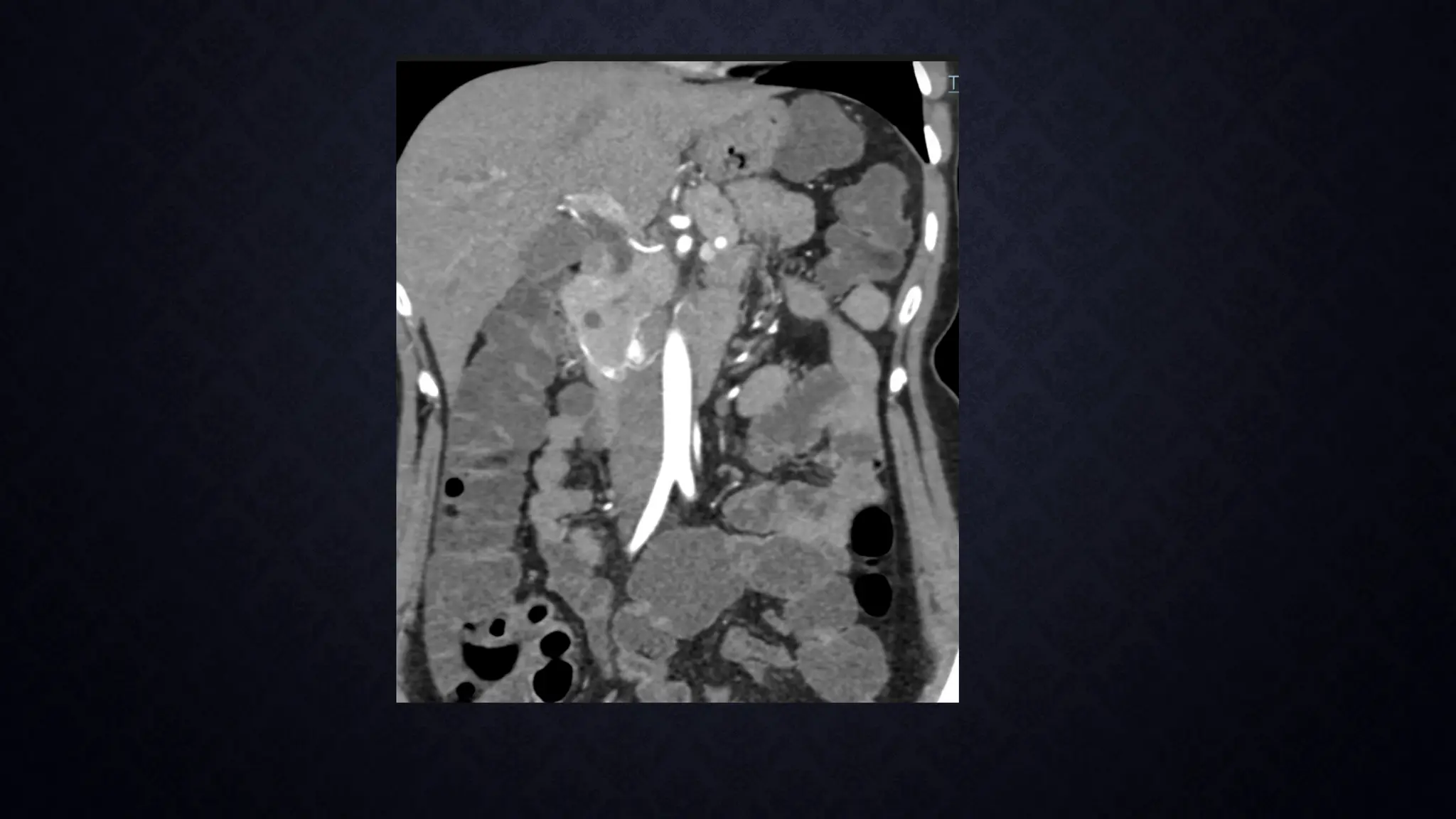 PANCREATIC NEUROENDOCRINE TUMORS RADIOLOGY | PPTX