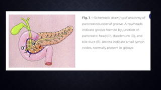 PANCREATIC NEUROENDOCRINE TUMORS RADIOLOGY | PPTX