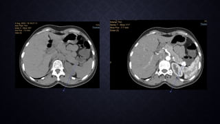 PANCREATIC NEUROENDOCRINE TUMORS RADIOLOGY | PPTX