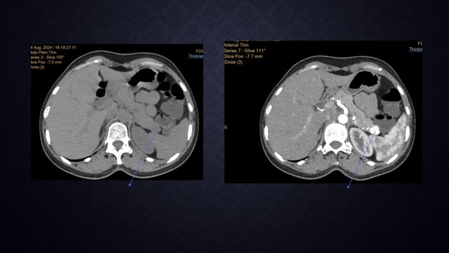 PANCREATIC NEUROENDOCRINE TUMORS RADIOLOGY | PPTX | Endocrine and ...