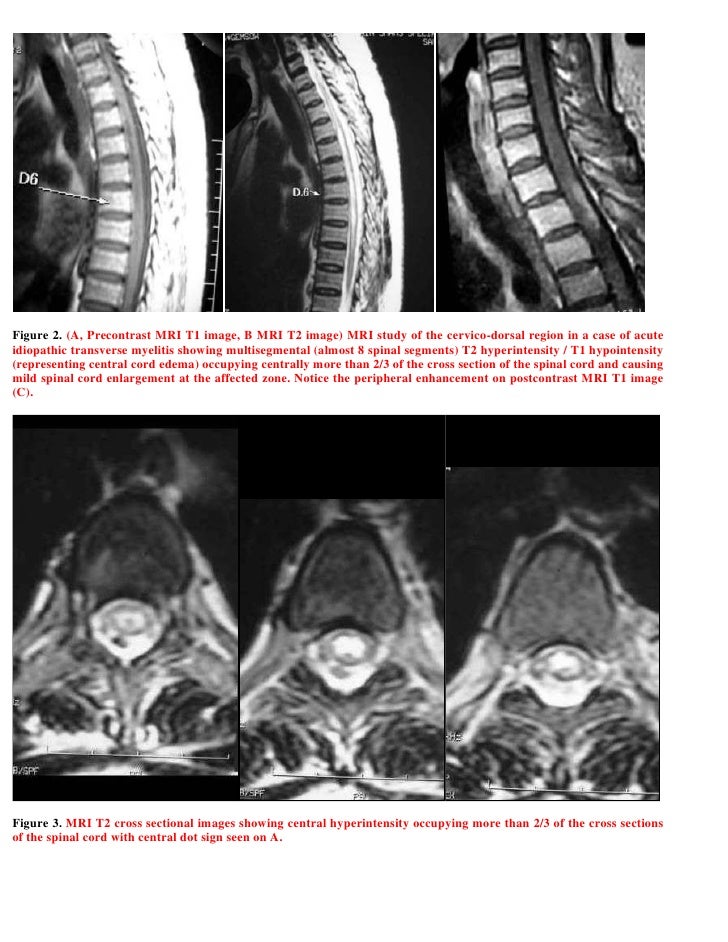 Case record...Idiopathic postinfectious transverse myelitis
