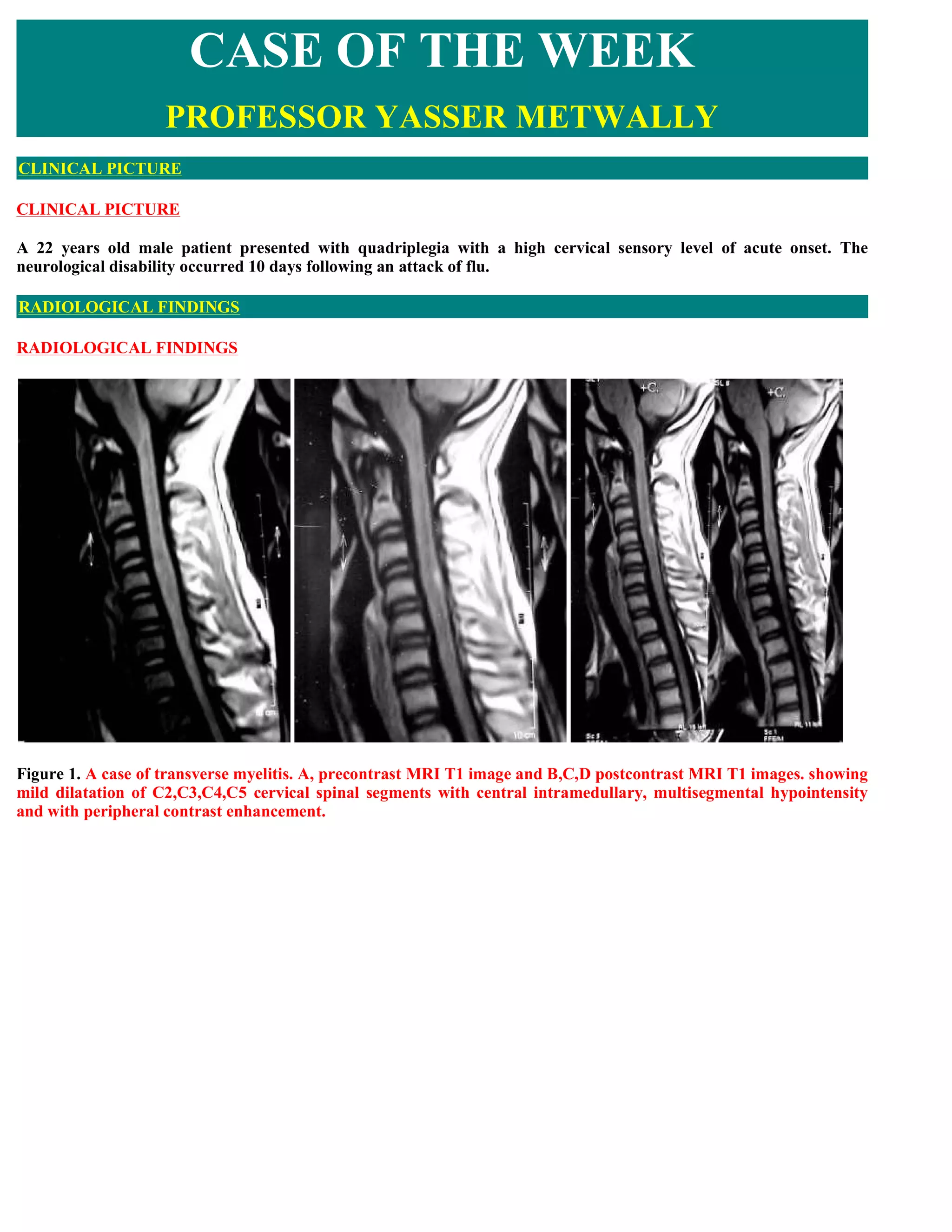 Case record...Idiopathic postinfectious transverse myelitis' | PDF