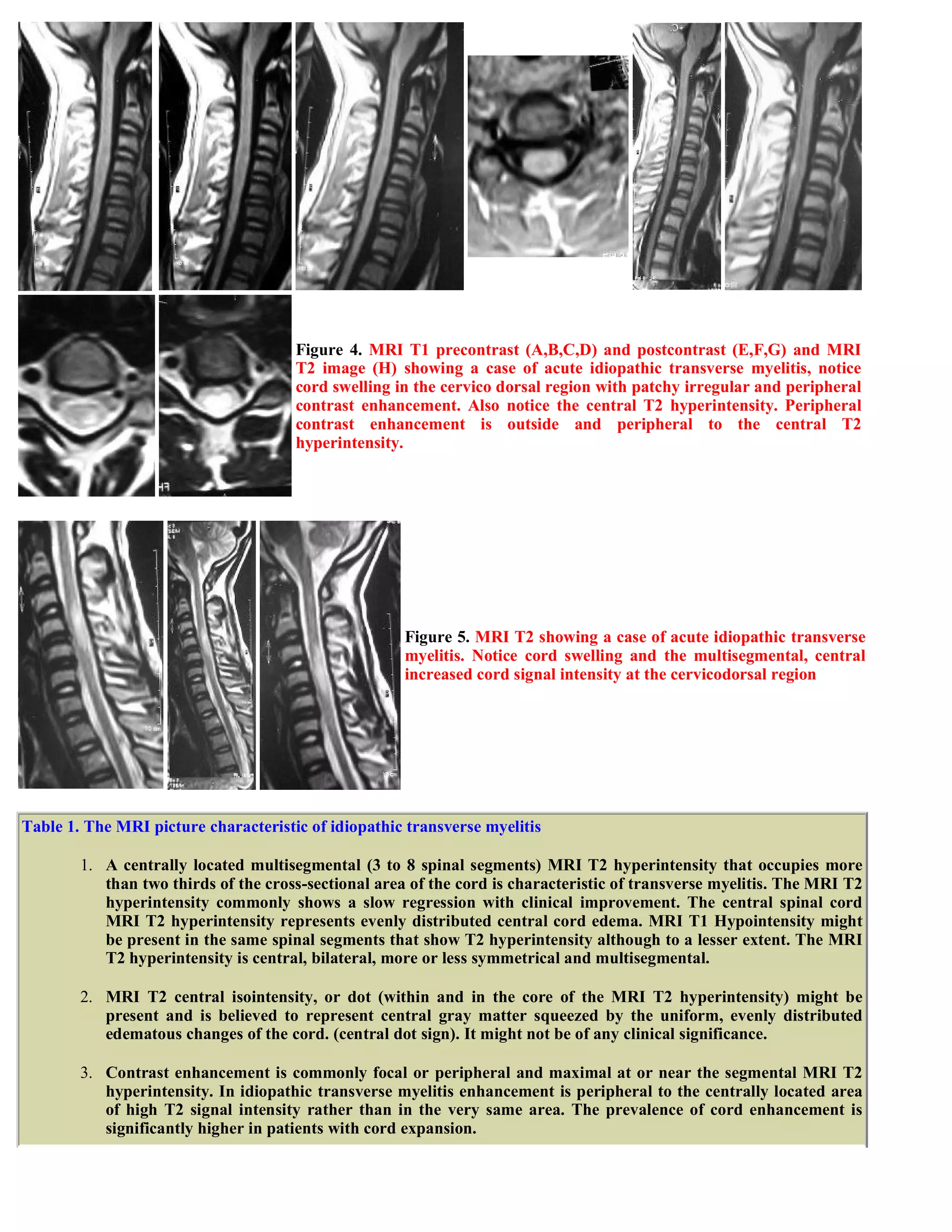 Case record...Idiopathic postinfectious transverse myelitis' | PDF