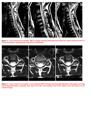 Case record...Idiopathic postinfectious transverse myelitis' | PDF