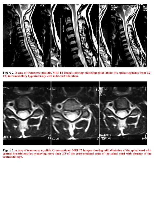 Case record...Idiopathic postinfectious transverse myelitis' | PDF