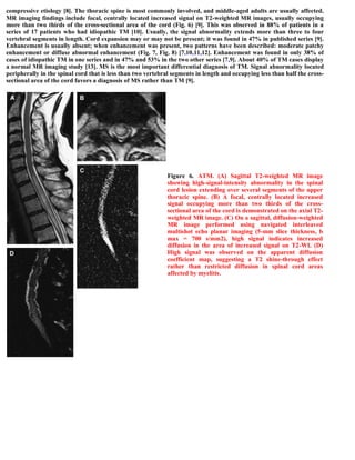 Case record...Idiopathic postinfectious transverse myelitis' | PDF