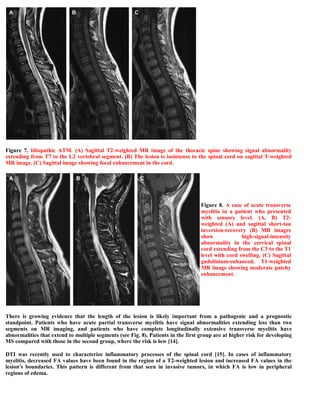 Case record...Idiopathic postinfectious transverse myelitis' | PDF