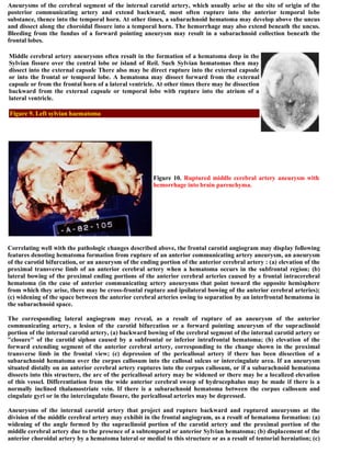 Case record...Ruptured anterior communicating aneurysm | PDF